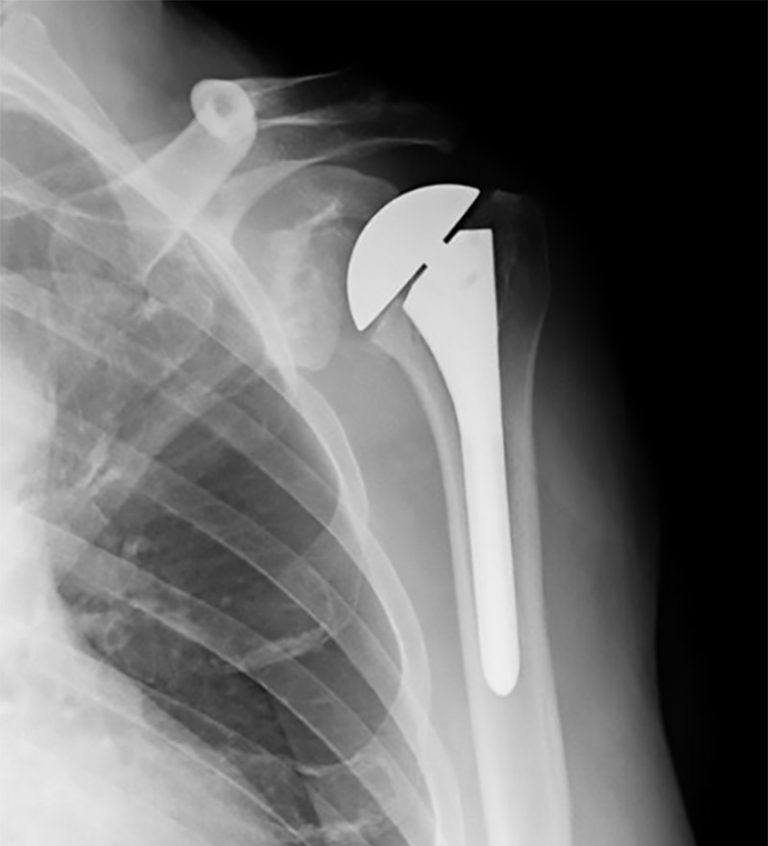Minimally Invasive Total Shoulder Replacement - St. Vincent's ...