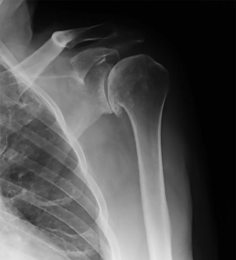 Minimally Invasive Total Shoulder Replacement - St. Vincent's ...